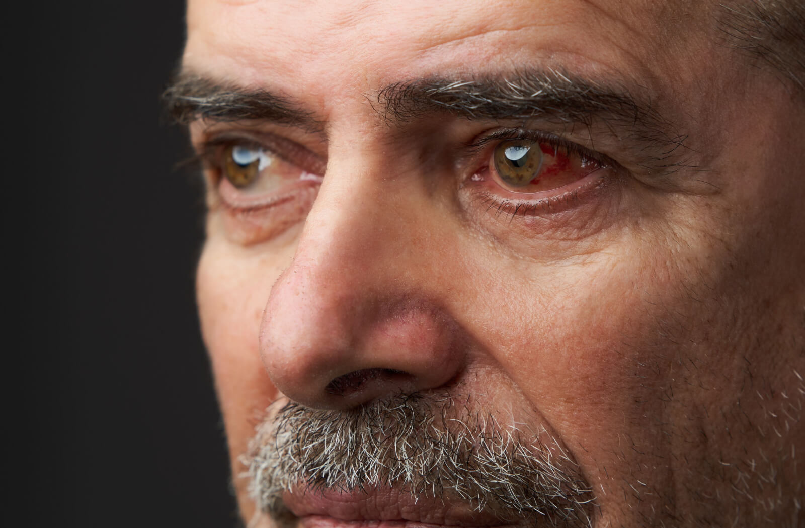 What Happens If You Don t Treat Dry Eyes 
